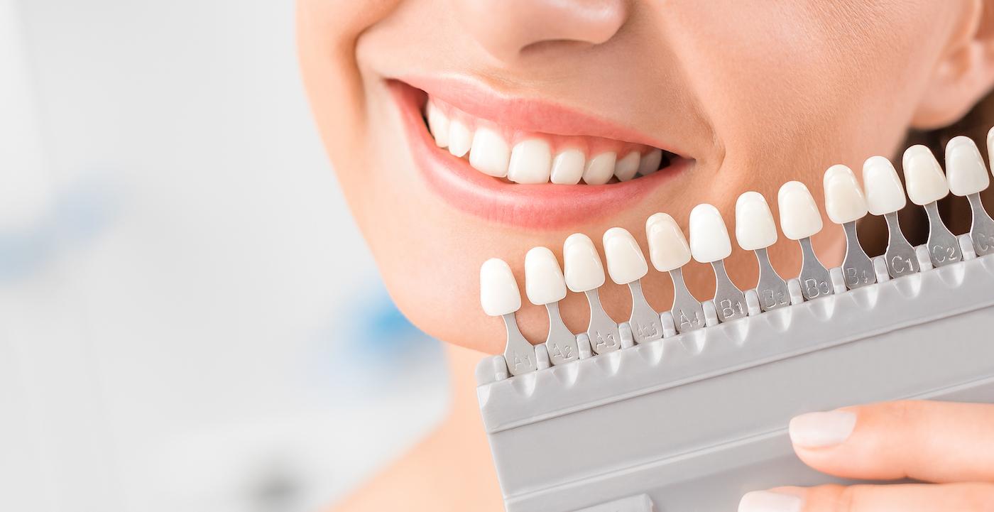 How long does dental veneers last? - Matizz Veneers Official How long does dental veneers last? - Matizz Veneers Official