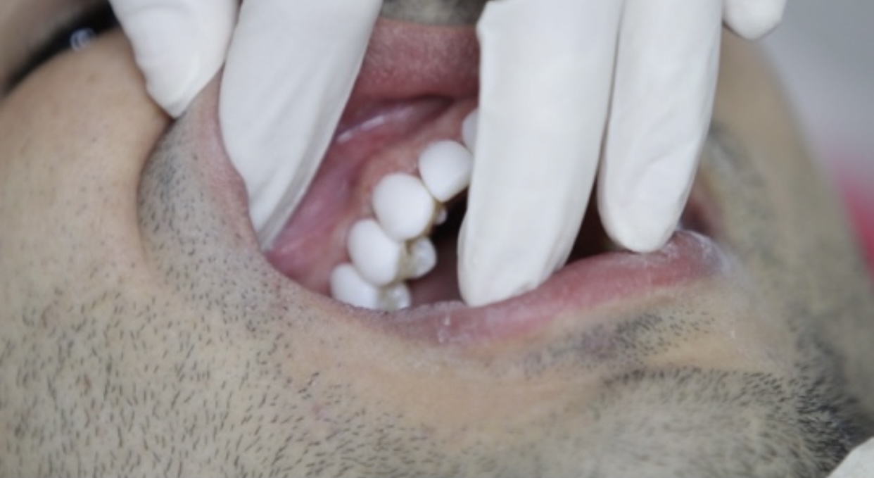 How long does dental veneers last? - Matizz Veneers Official How long does dental veneers last? - Matizz Veneers Official